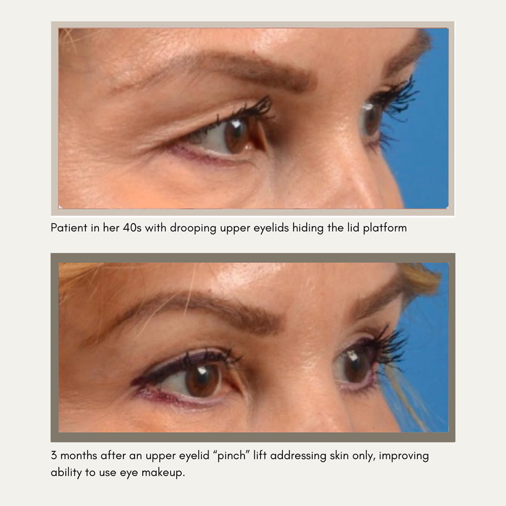 Upper Eyelid Lift: Big Results With a Small Procedure