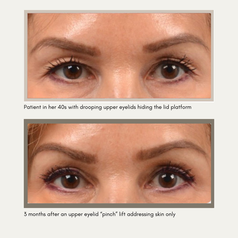 Eyelid Lift: A Quick Fix for a Big Impact | Blog