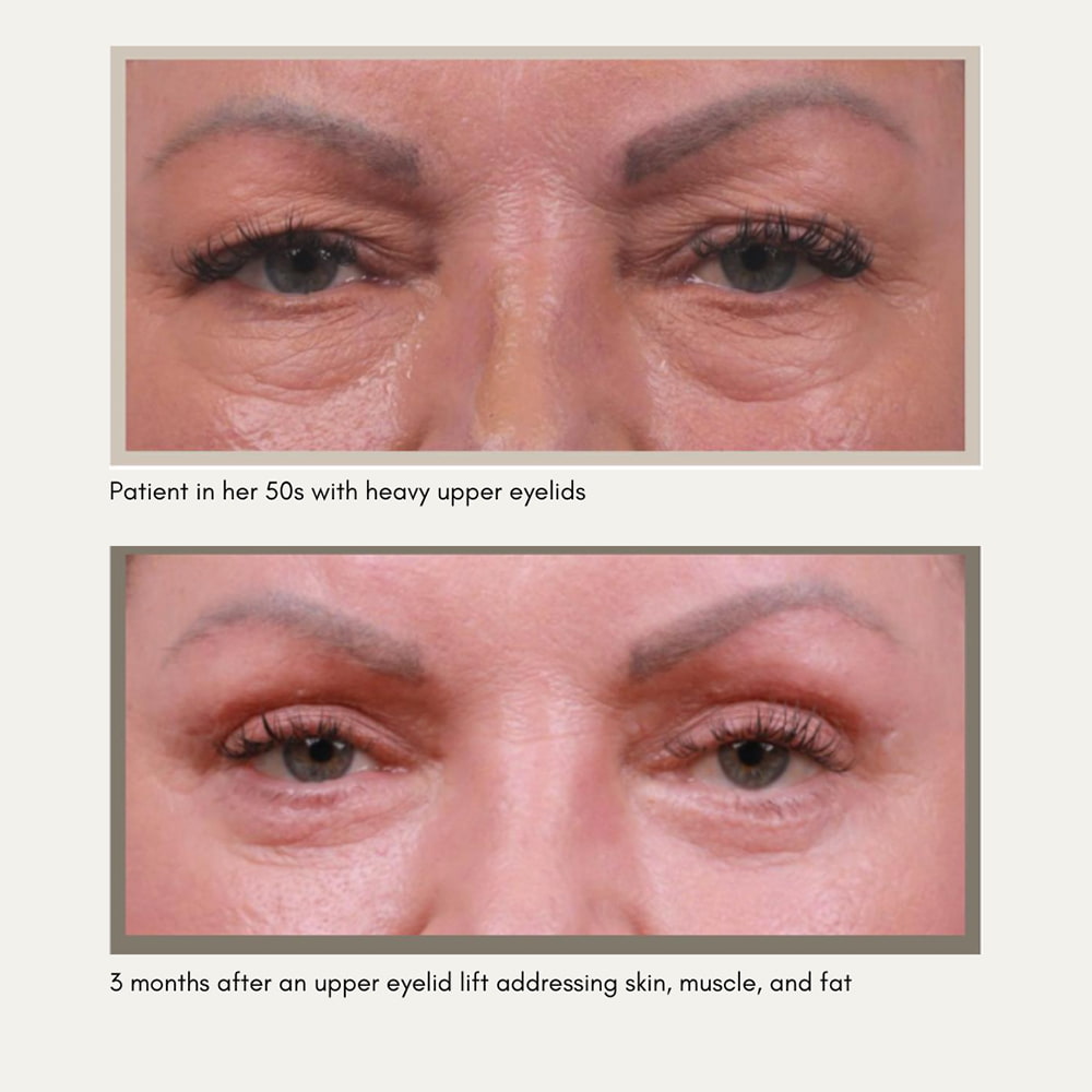 Upper Eyelid Lift: Big Results With a Small Procedure