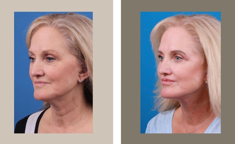 SMAS vs. Deep Plane Facelift: Which Technique Fits You?