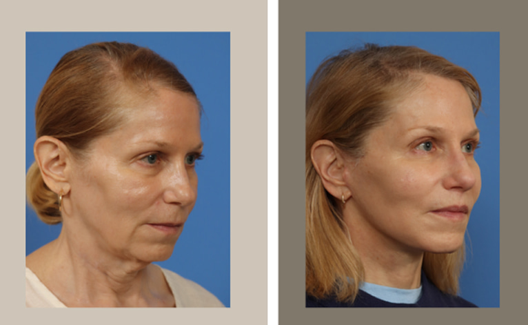 SMAS vs. Deep Plane Facelift: Which Technique Fits You?