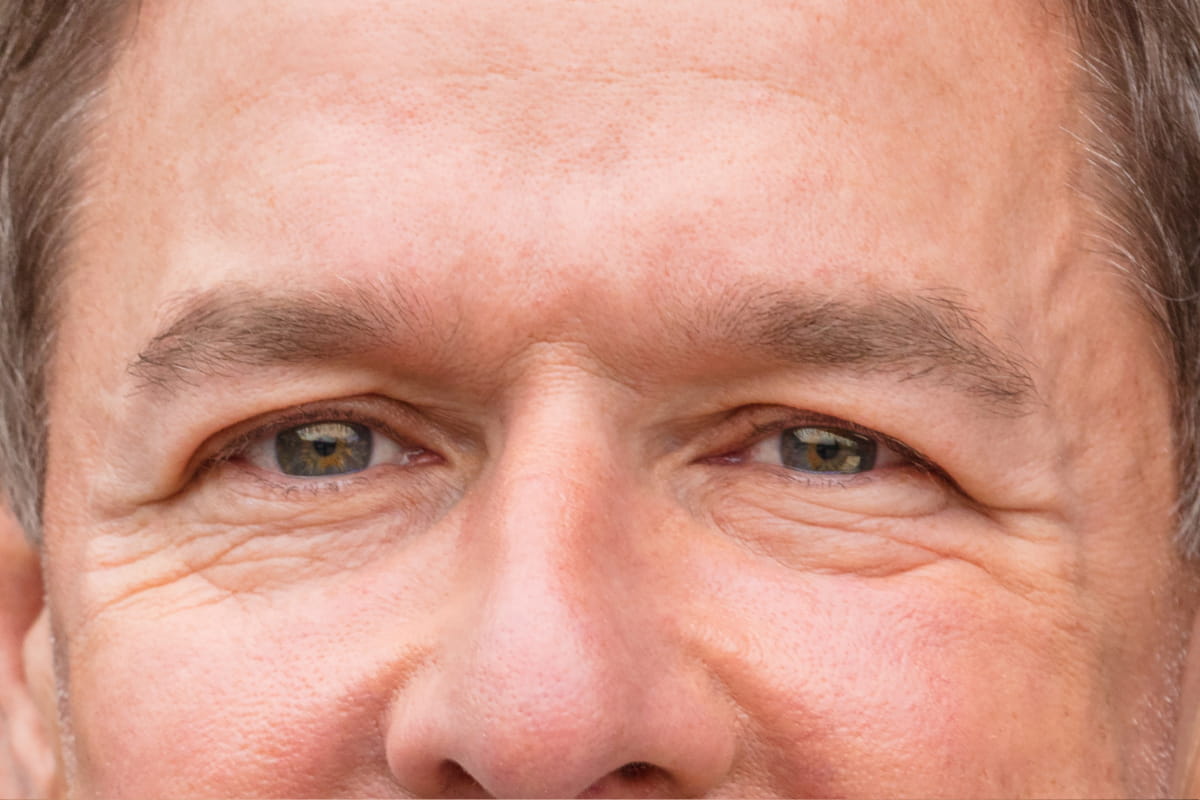 Eyelid Surgery for Men: Natural, Sharper Eye Results