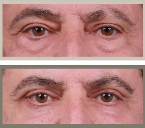 Eyelid Surgery for Men: Natural, Sharper Eye Results