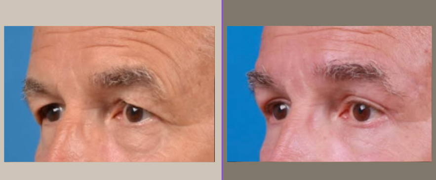 Eyelid Surgery for Men: Natural, Sharper Eye Results