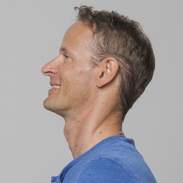 Neck Lift New York | Brooklyn Facial Cosmetic Surgery